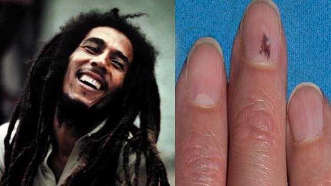 Bob Marley Hautkrebs